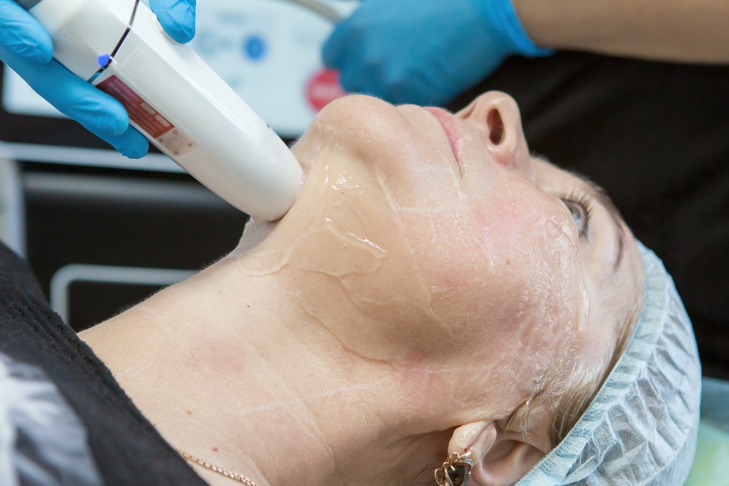 The Ultimate Guide to Laser Skin Resurfacing: What to Expect Before ...