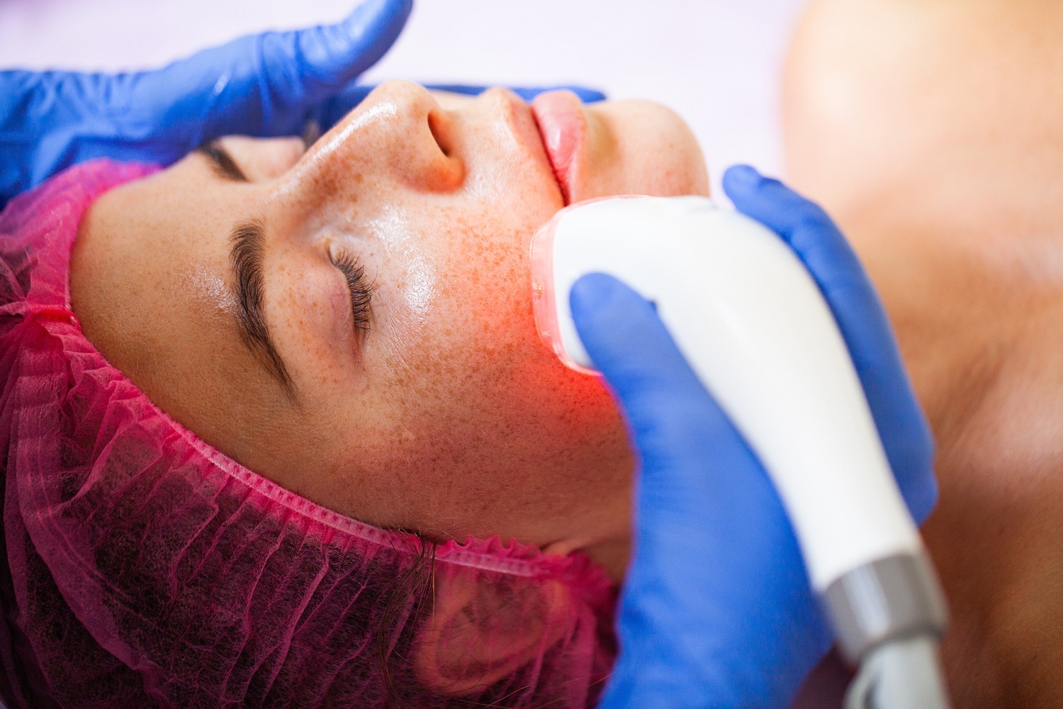 Laser Treatment for Rosacea - Dr Refresh