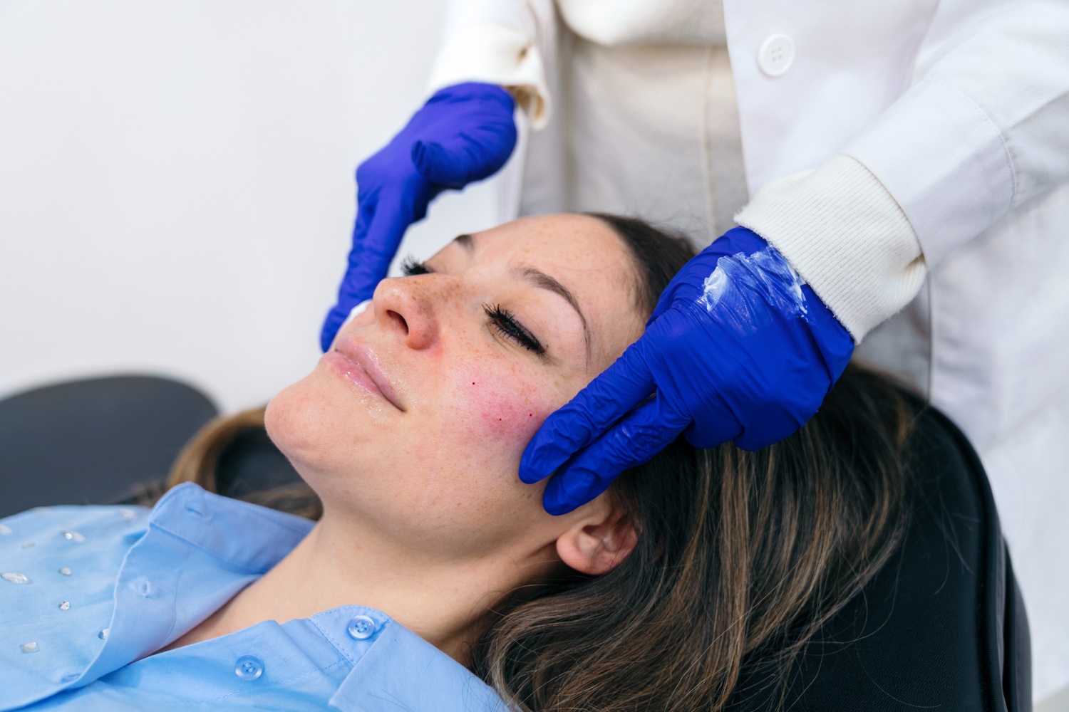 Rosacea & Menopause: Understanding The Link & Treatment Options - Dr ...